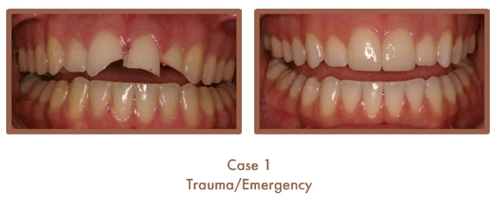 Before & After Gallery, Cosmetic Dentistry Before After Photo Gallery ...